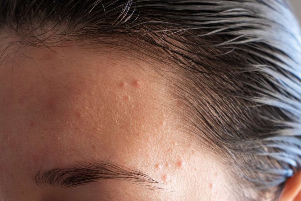 How To Get Rid Of Forehead Acne - Her Beauty Plug